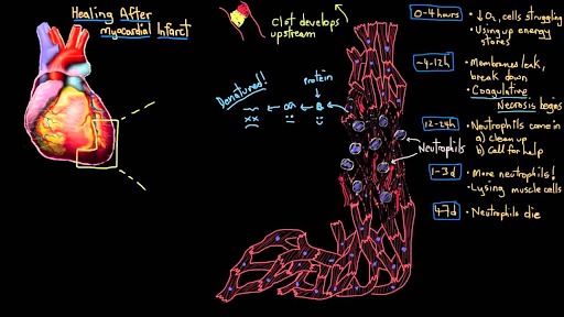 Myocardial Infarction Animation